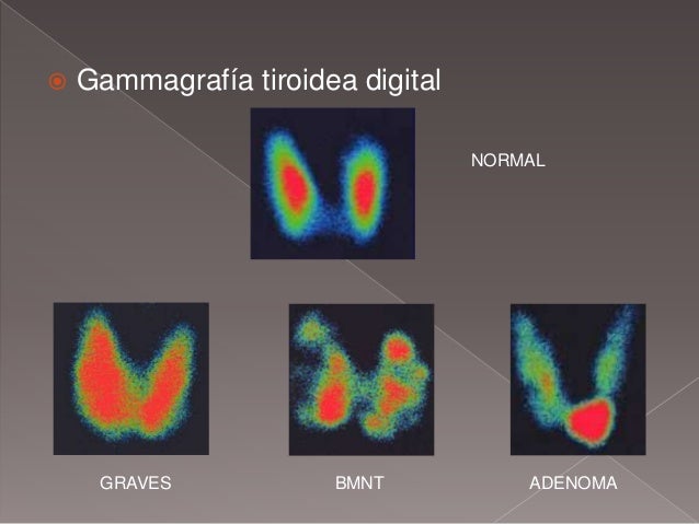 (2016 04-05)hipertiroidismo(ppt)