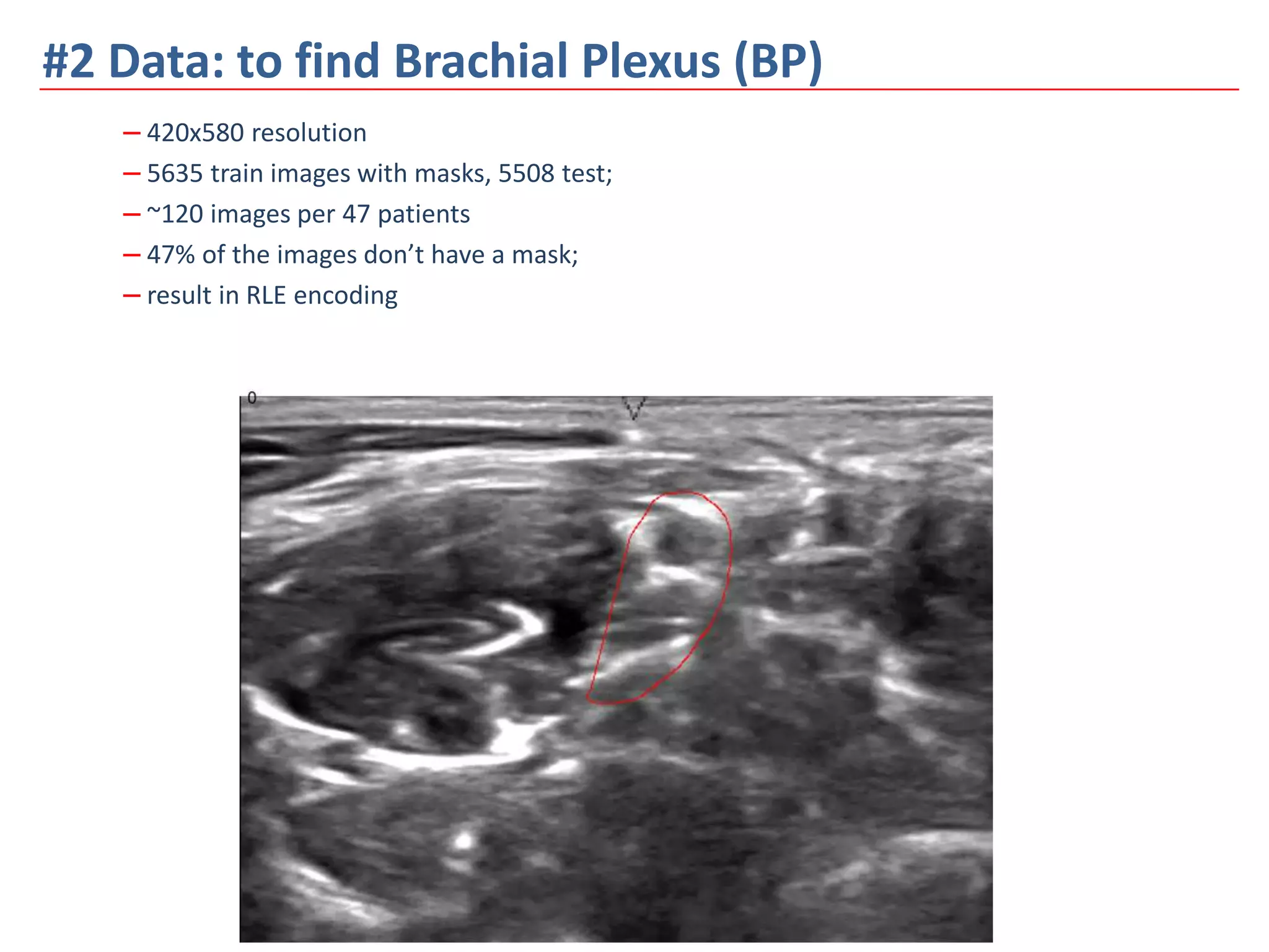 Ultrasound nerve segmentation, kaggle review | PPTX