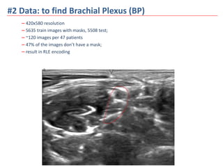 Ultrasound nerve segmentation, kaggle review | PPTX