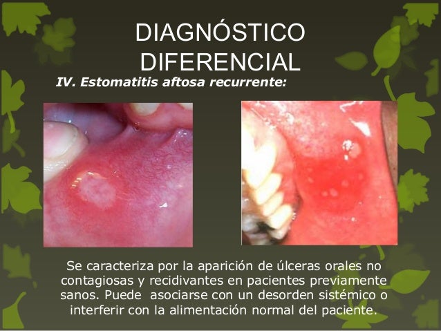 (2016.03.08) Estomatitis prótesica (PPT)