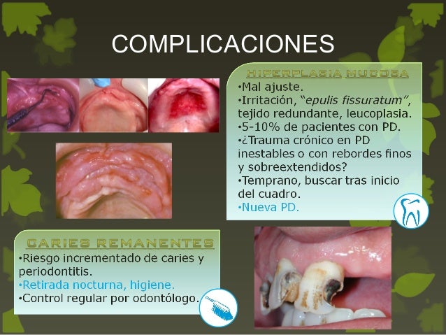 (2016.03.08) Estomatitis prótesica (PPT)