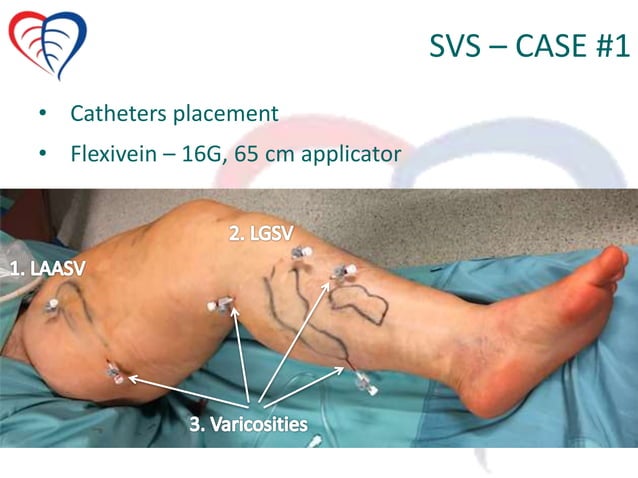 Potential advantages of steam ablation of varicose veins | PPT