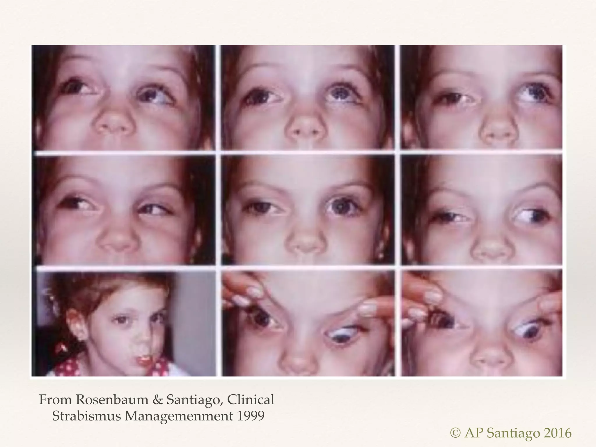 2016 asmph strabismus & amblyopia | PPT
