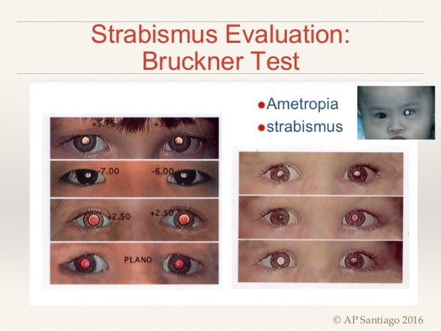 2016 asmph strabismus & amblyopia