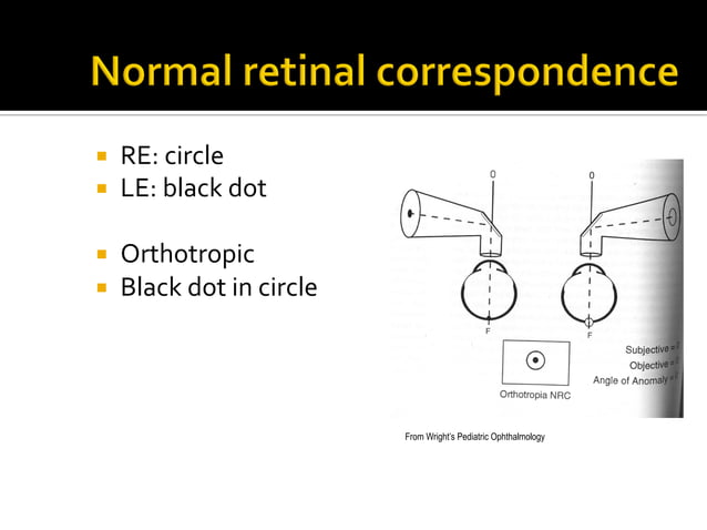 2016 I. Binocular Vision & Retinal Correspondence; II Amblyopia | PDF