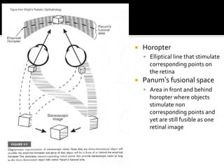 2016 I. Binocular Vision & Retinal Correspondence; II Amblyopia | PDF