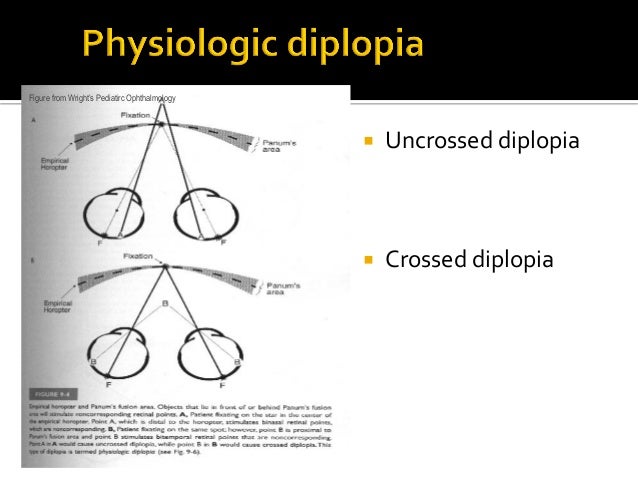 2016 I. Binocular Vision & Retinal Correspondence; II Amblyopia