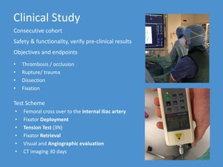 Pre-cannulated f/b-EVAR using guidewire fixator | PPT