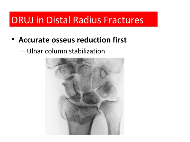 Οξεία Αστάθεια της Άπω Κερκιδωλενικής 016/ Acute DRUJ Instability 016 | PPT