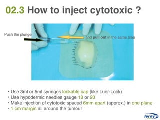 Electrochemotherapy : principles, sessions, case studies, and machines ...