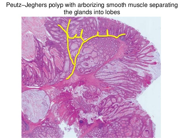 Gastrointestinal Polyps Peutzjeghers Syndrome Pjs