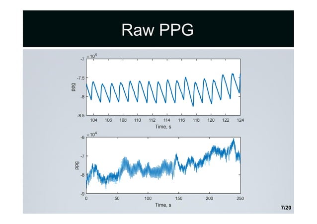 Photoplethysmography Based System For Atrial Fibrillation Detection During Hemodialysis Ppt