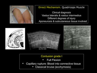 Ramon Balius - Quadriceps Muscle Injuries Diagnosis | PPT