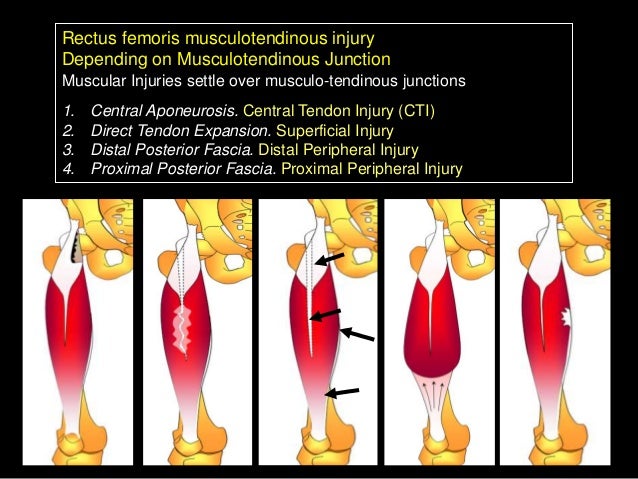 Ramon Balius - Quadriceps Muscle Injuries Diagnosis