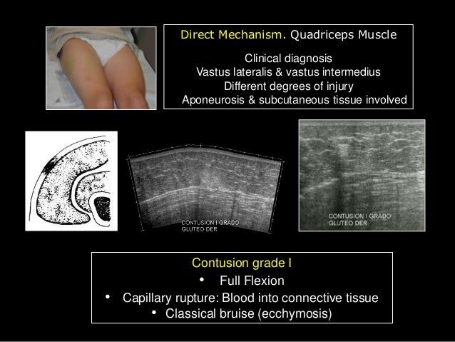 Quadriceps Strain Contusions Assessment Diagnosis