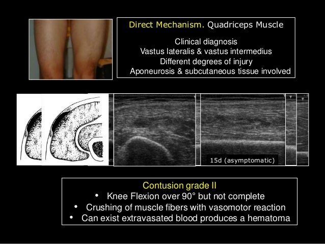 Quadriceps Strain Contusions Assessment Diagnosis
