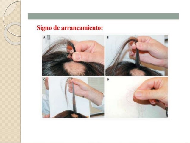(2017 02-23)alopecia introducción, clasificación y diagnóstico(ppt)
