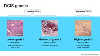 DCIS: What You Need to Know | PPTX
