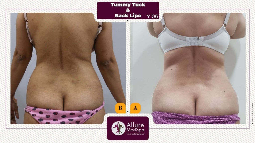 Tummy Tuck Surgery Abdominoplasty By Drmilan Doshi Andheri Mumbai Ppt