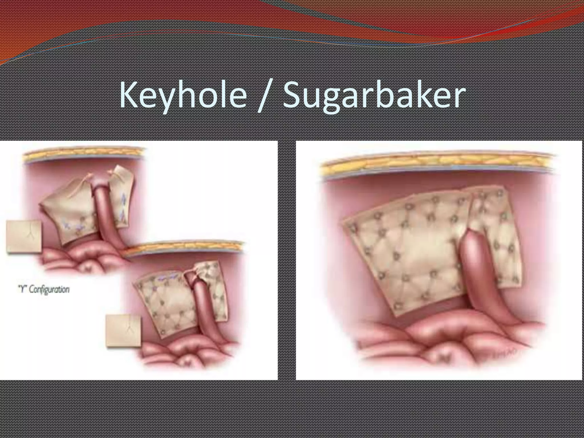 2017.parastomal hernia in colorectal cancer | PPTX