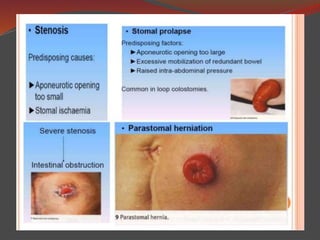 2017.parastomal hernia in colorectal cancer | PPTX