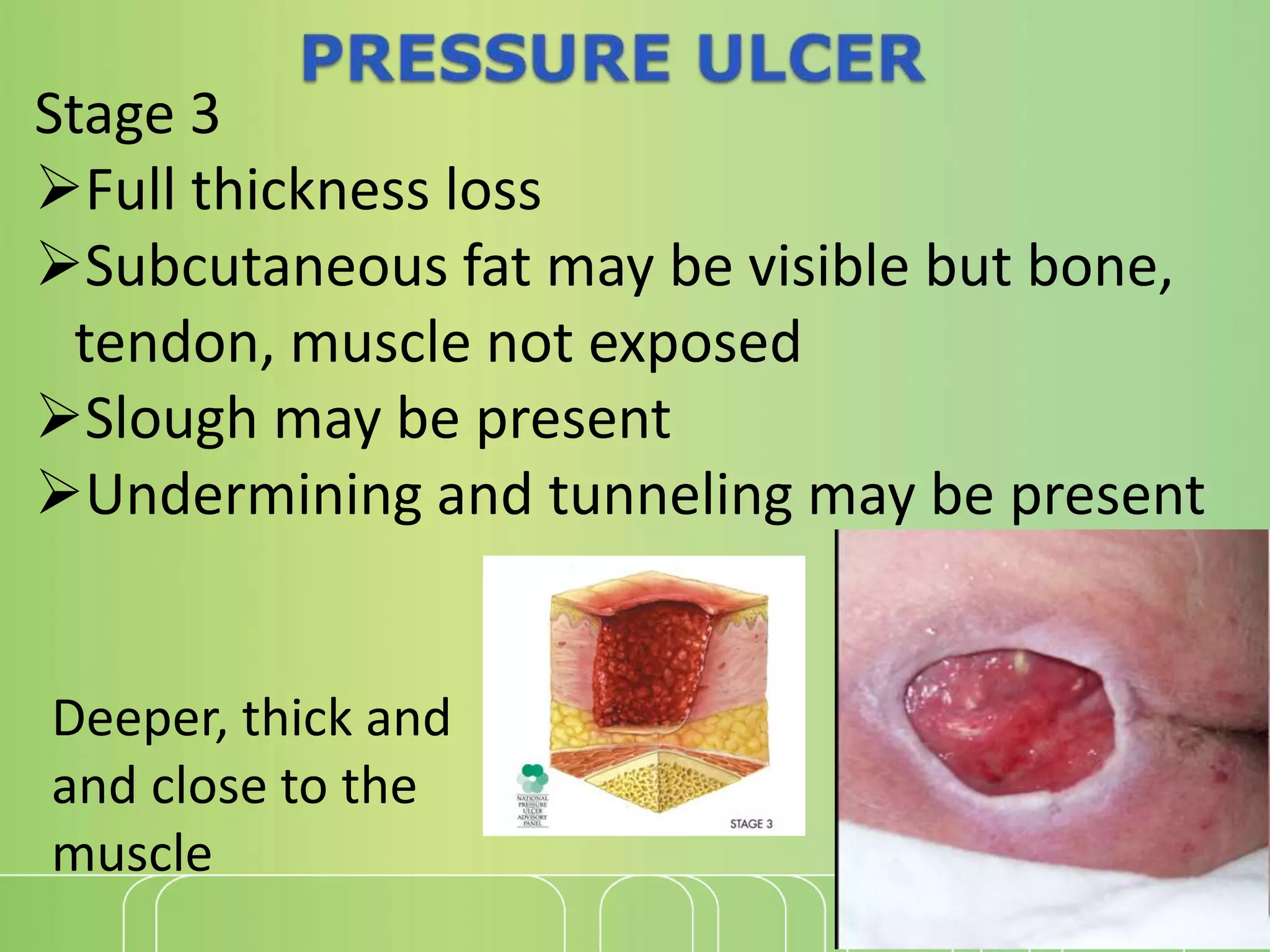 Pressure Ulcer | PPTX