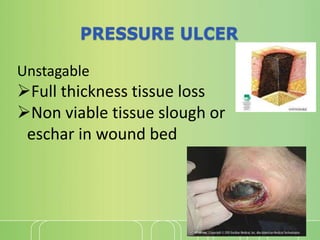 Pressure Ulcer | PPTX