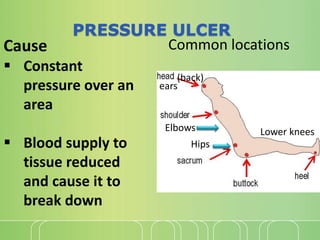 Pressure Ulcer | PPTX