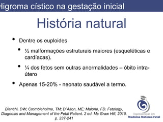 Higroma Cístico no Primeiro Trimestre - Mariana Rialto | PPTX