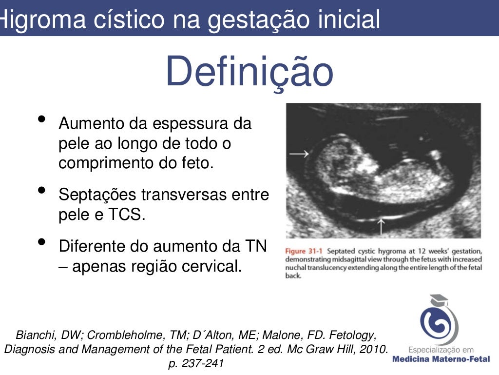 Higroma Cístico no Primeiro Trimestre - Mariana Rialto