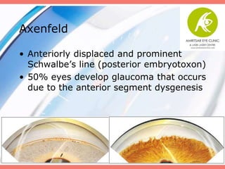 glaucoma n cornea | PPTX