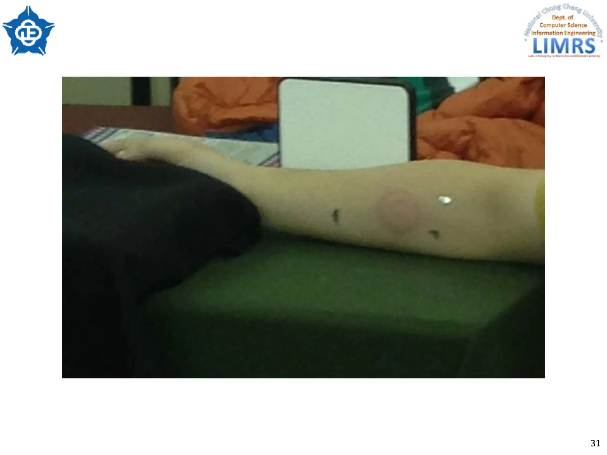 Hyperspectral imaging of bedsore and a simulation study for wound ...