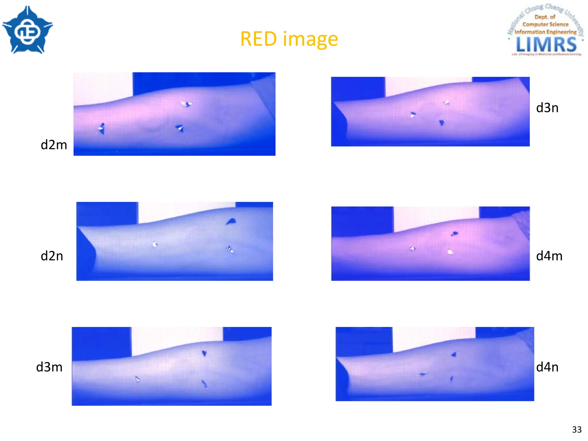 Hyperspectral imaging of bedsore and a simulation study for wound ...