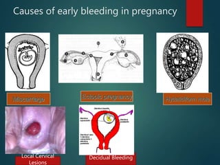 Bleeding in early pregnancy | PPT