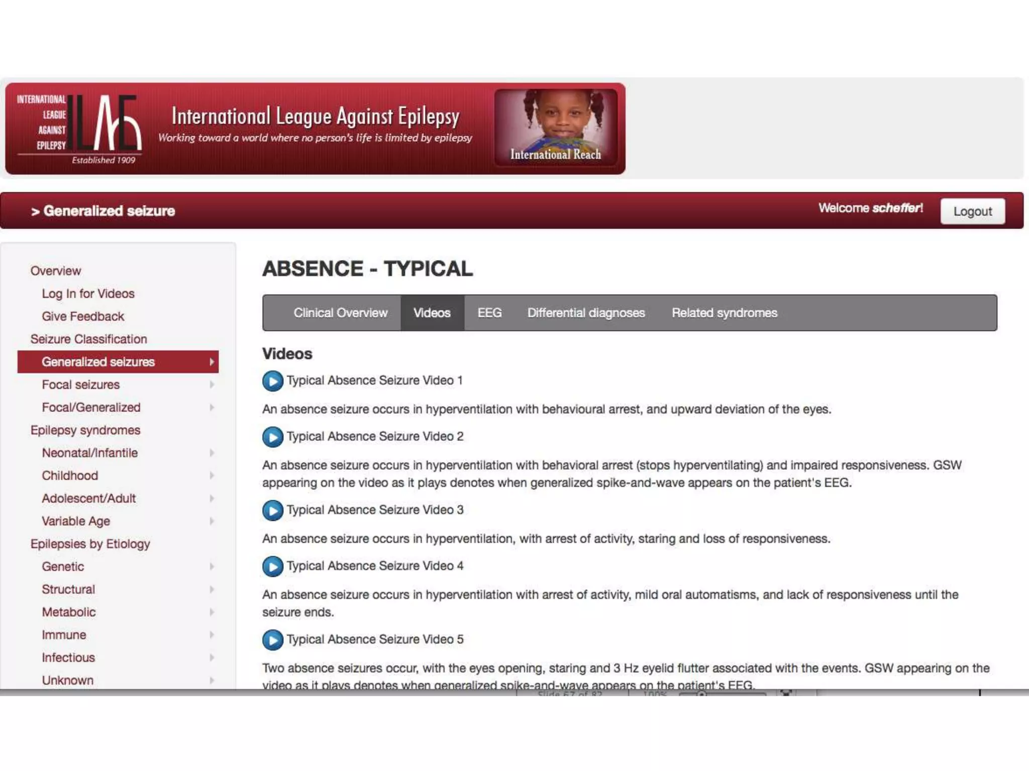 2017 revised ILEA classification of seizures | PPTX