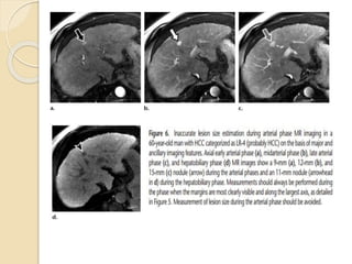 2017 version of li rads for ct and mr | PPT