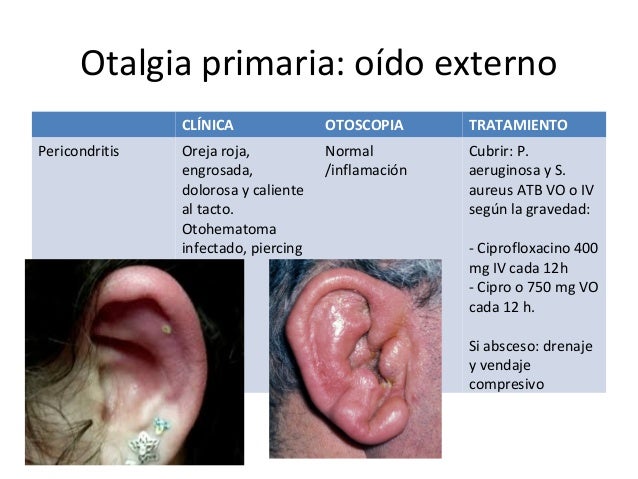 (2018 01-09) otalgia (ppt)