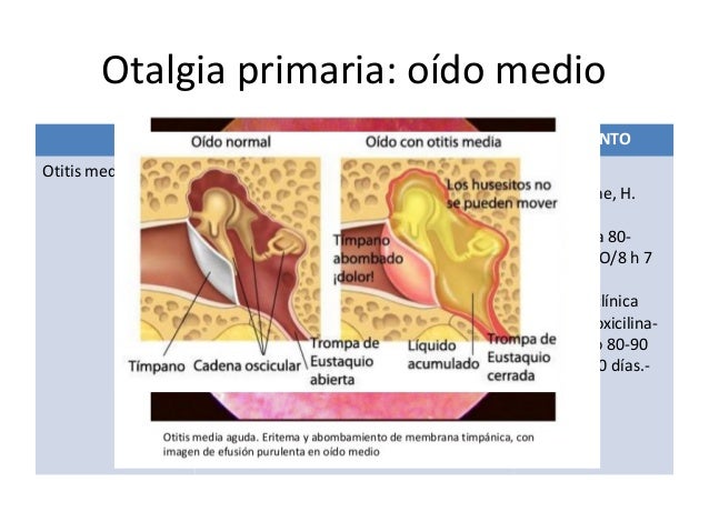 (2018 01-09) otalgia (ppt)