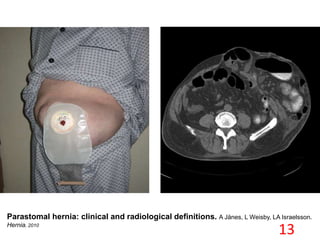 2018.parastomal hernias how to prevent... | PPT