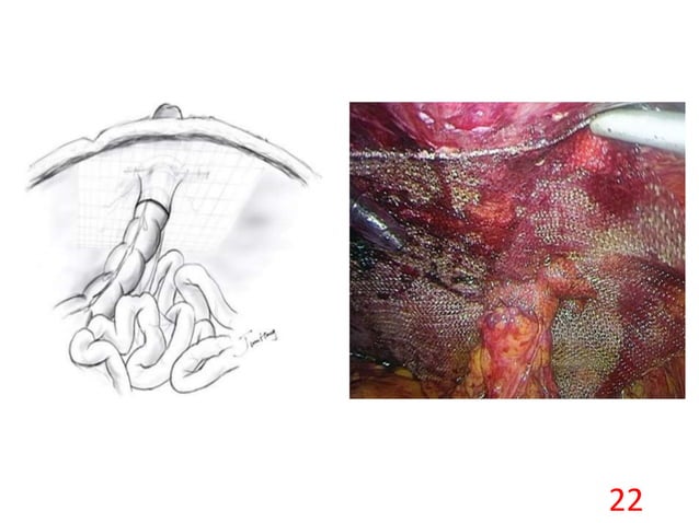 2018.parastomal hernias how to prevent... | PPT
