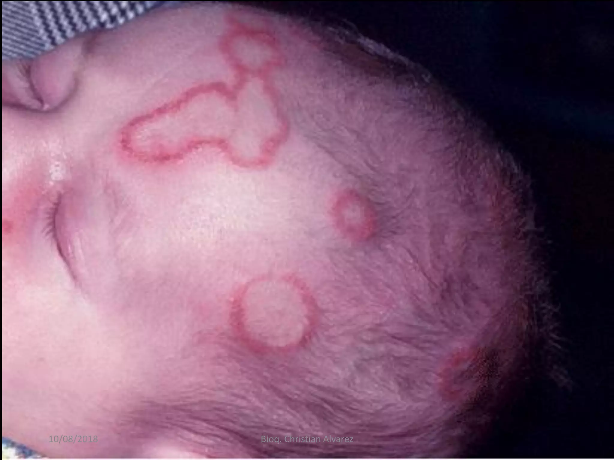 2018-4-Micosis-superficiales.pdf | Skin and Dermatology | Diseases and ...