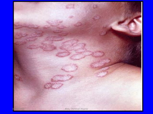 2018-4-Micosis-superficiales.pdf | Skin and Dermatology | Diseases and ...