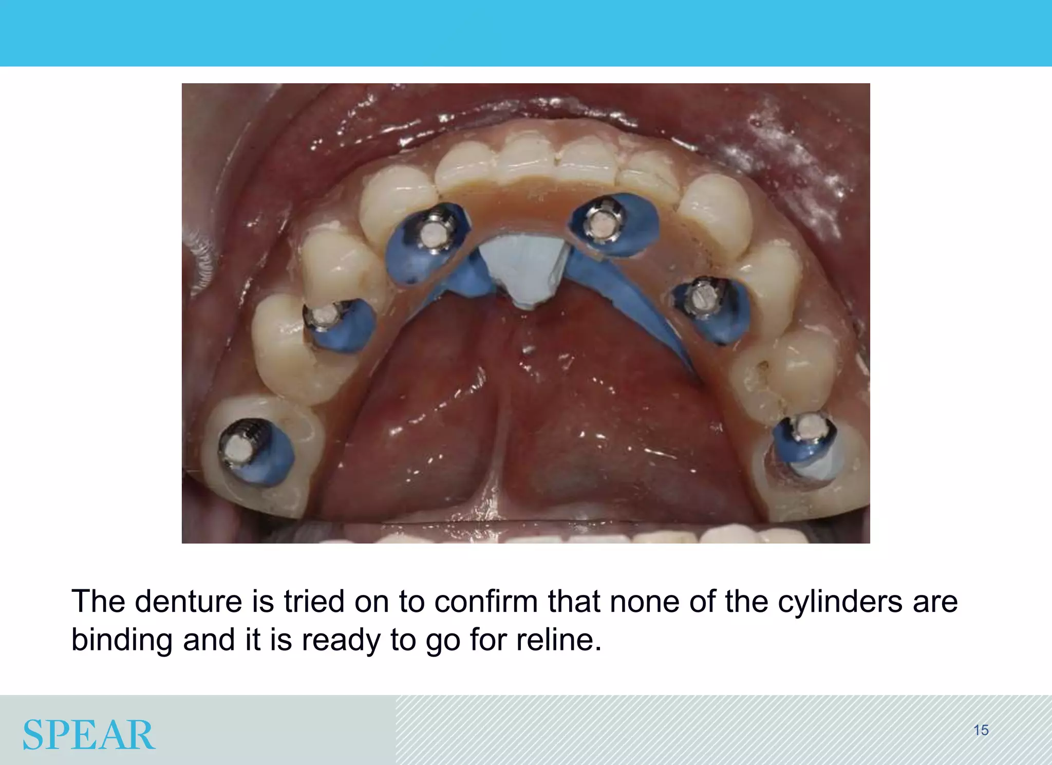 Conversion Prosthesis For an Implant-Supported Fixed Dental Prosthesis ...