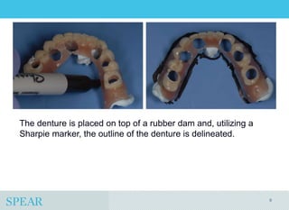 Conversion Prosthesis For an Implant-Supported Fixed Dental Prosthesis ...