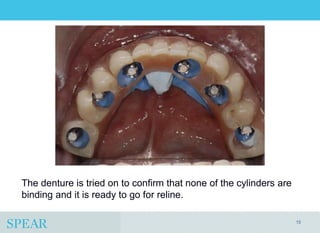 Conversion Prosthesis For an Implant-Supported Fixed Dental Prosthesis ...