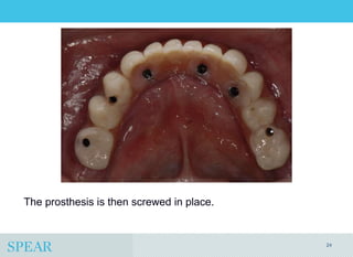 Conversion Prosthesis For an Implant-Supported Fixed Dental Prosthesis ...