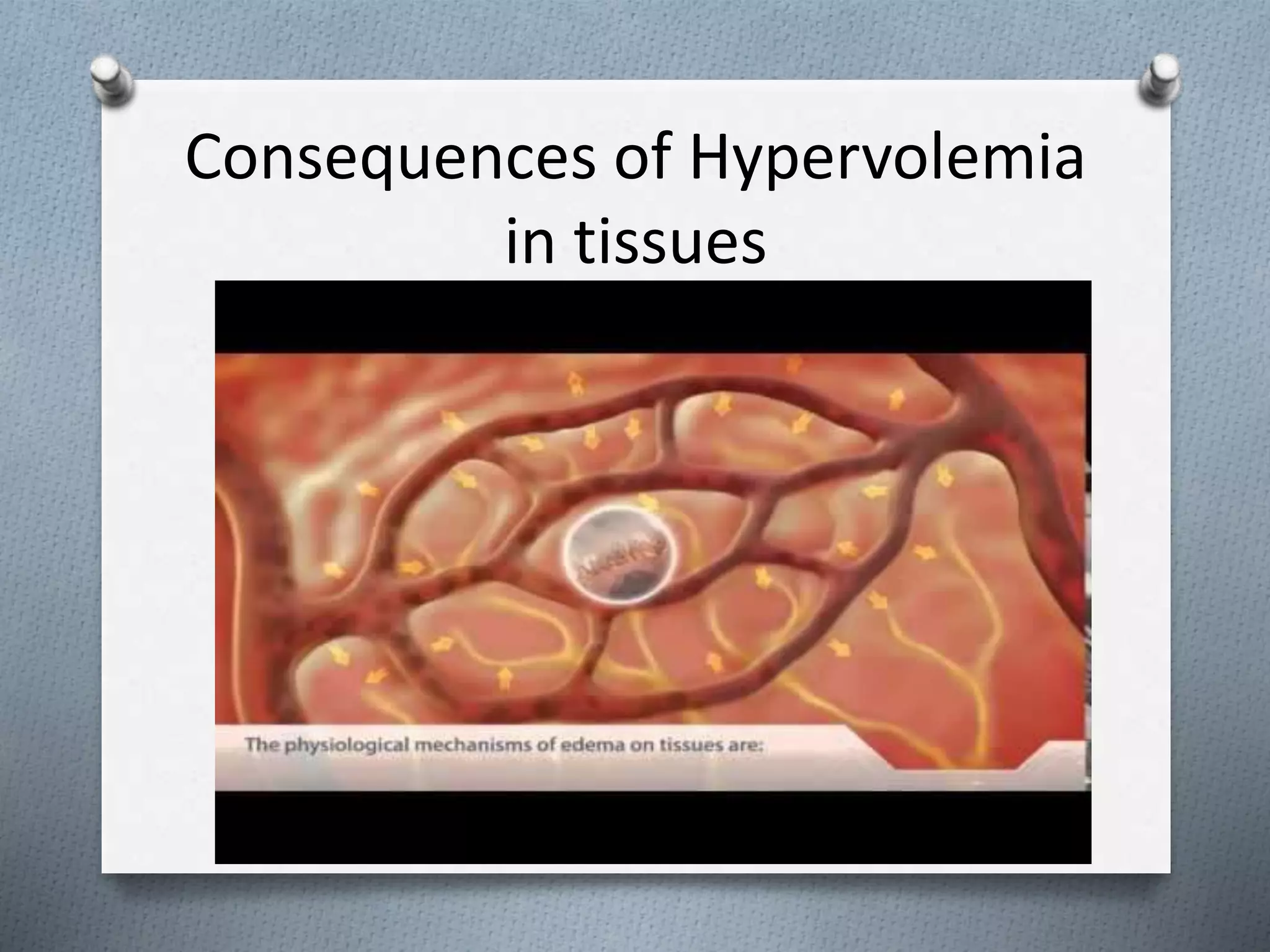 Hypervolemia (Fluid overload) | PPTX