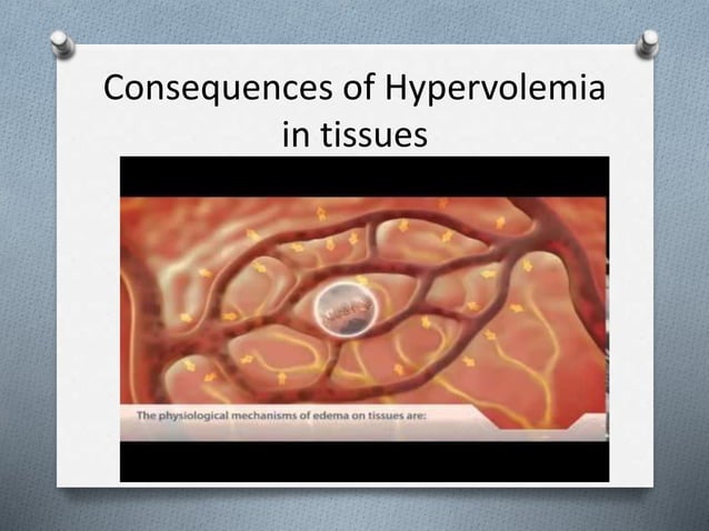 Hypervolemia (Fluid overload) | PPT