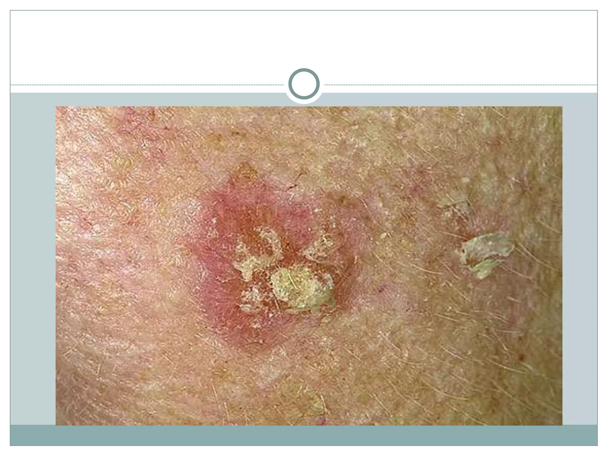 20181110 wound healing richard bodor_basics of wounds, lumps, bumps ...