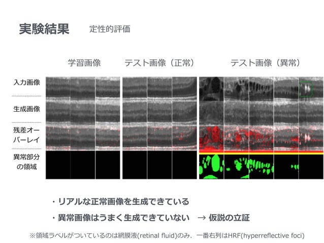 Unsupervised Anomaly Detection with Generative Adversarial Networks to Guide Marker Discovery | PDF